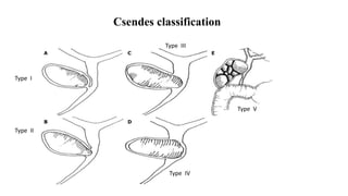 Mirizzi syndrome ppt | PPTX