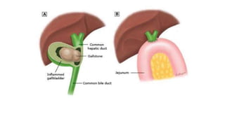Mirizzi syndrome ppt | PPTX
