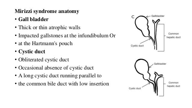Mirizzi syndrome ppt