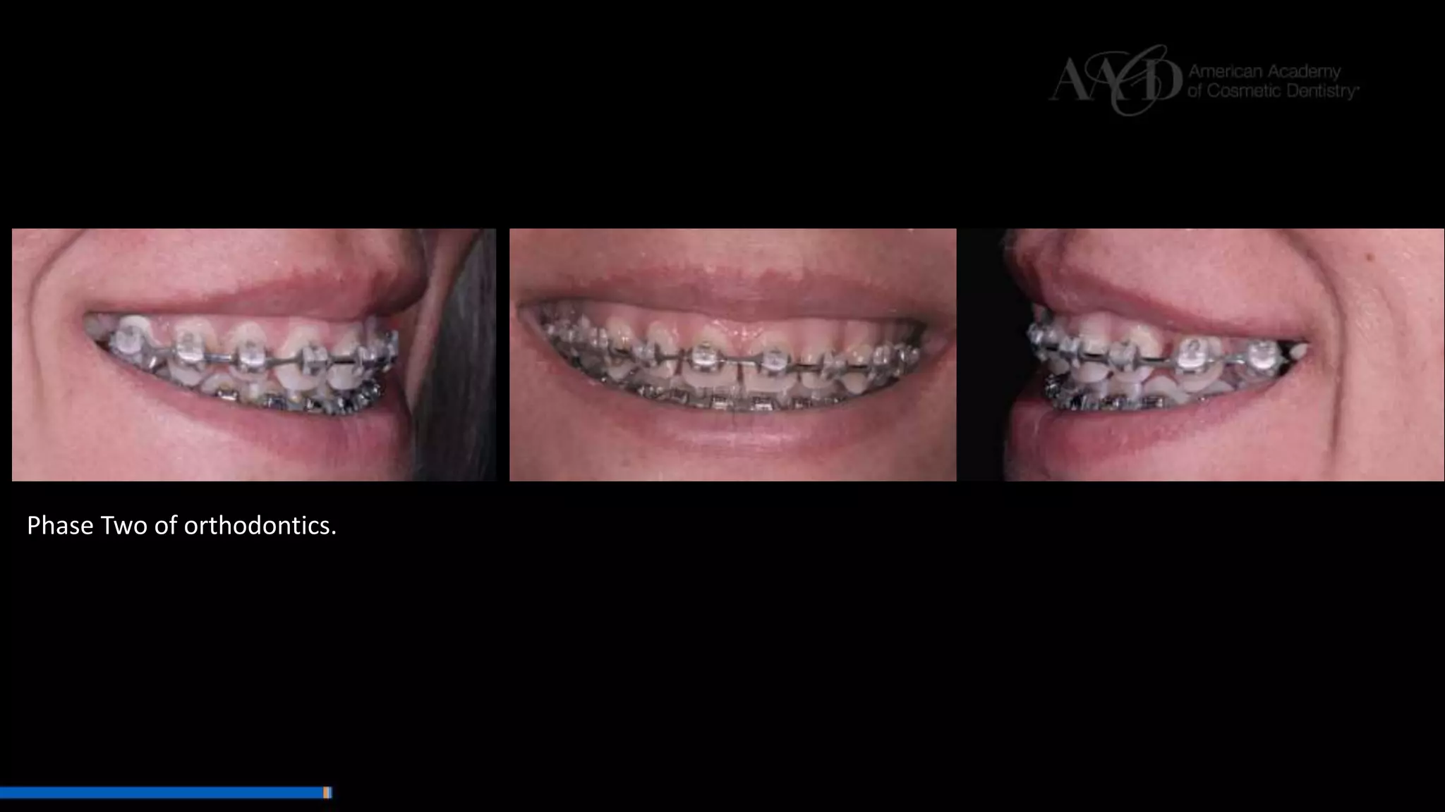 Esthetic Smile Design | PDF