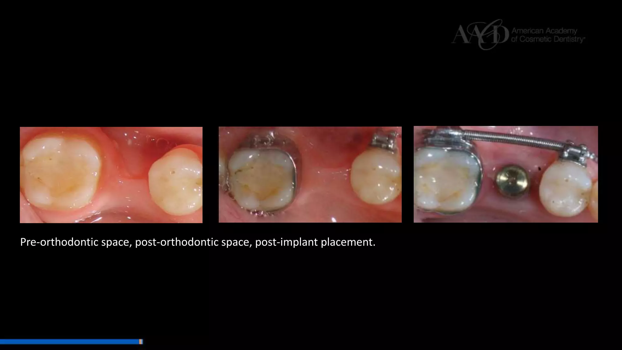 Esthetic Smile Design | PDF