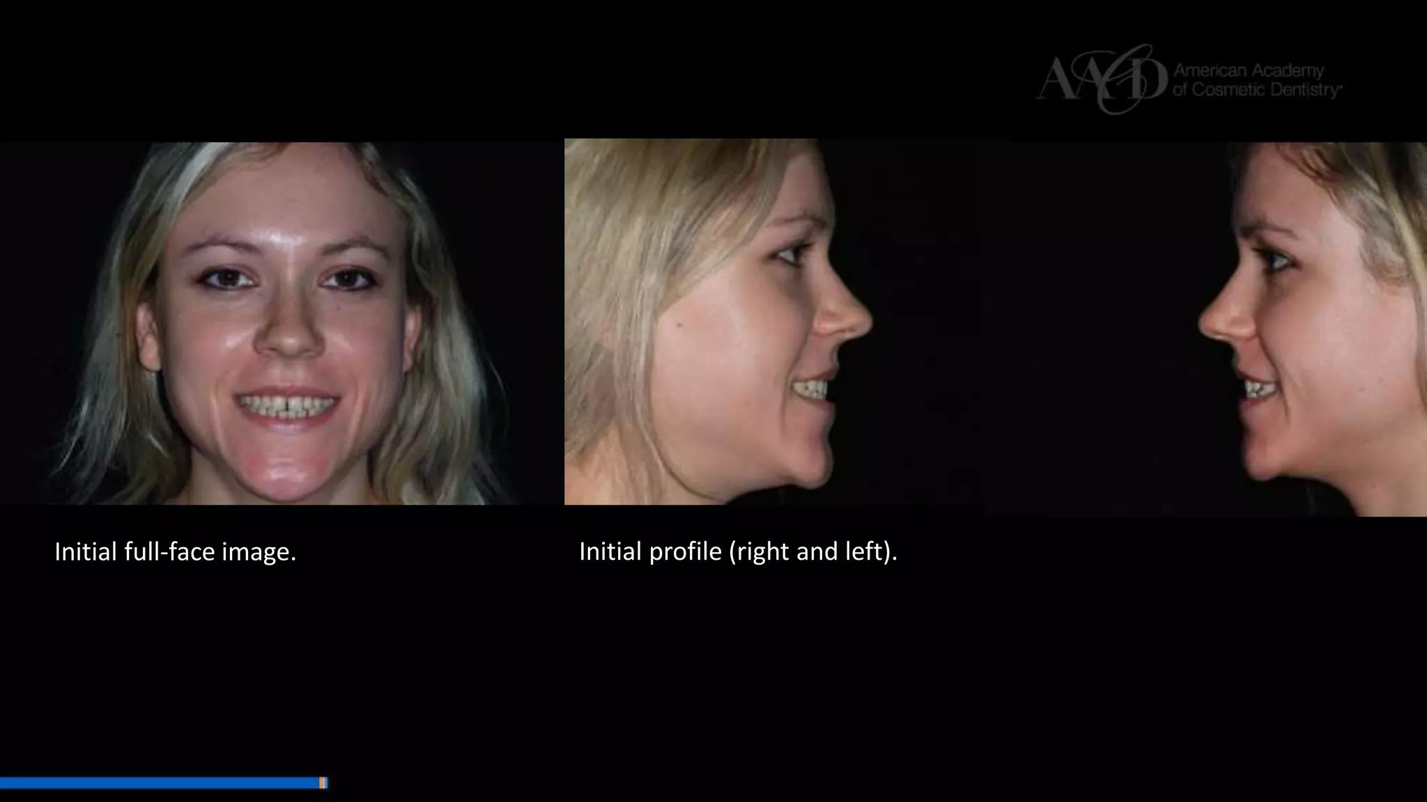 Esthetic Smile Design | PDF