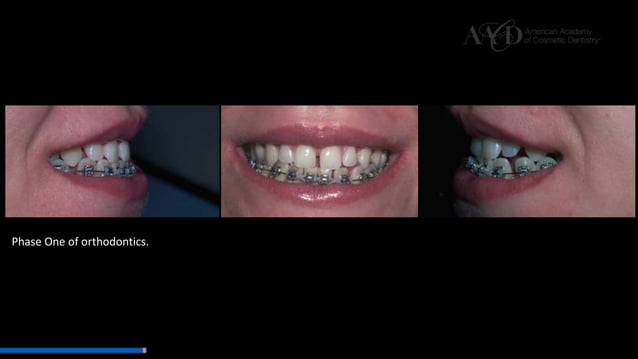 Esthetic Smile Design | PDF | Dental Health | Diseases and Conditions