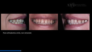 Esthetic Smile Design | PDF