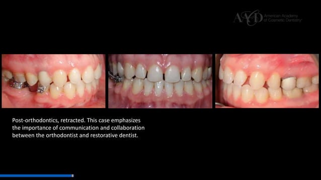 Esthetic Smile Design | PDF | Dental Health | Diseases and Conditions