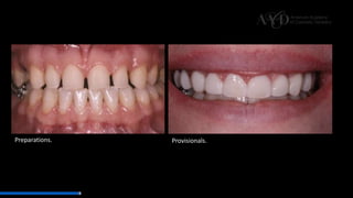 Esthetic Smile Design | PDF