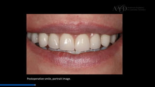 Esthetic Smile Design | PDF