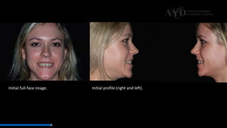 Esthetic Smile Design | PDF