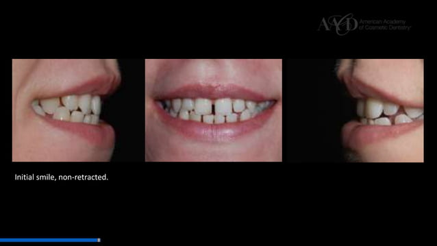 Esthetic Smile Design | PDF | Dental Health | Diseases and Conditions