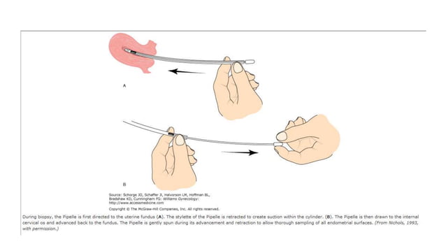 minimal invasive surgeries in dysfunctional uterine bleeding | PPT