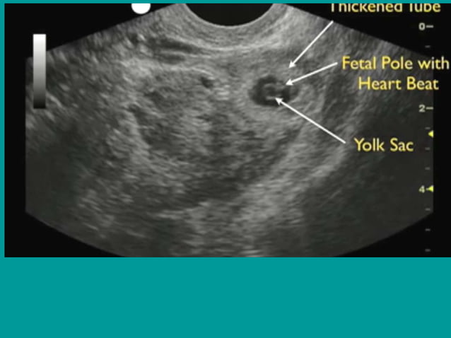 Miscarriage-and-Ectopic-Slides.powerpoint | PPT