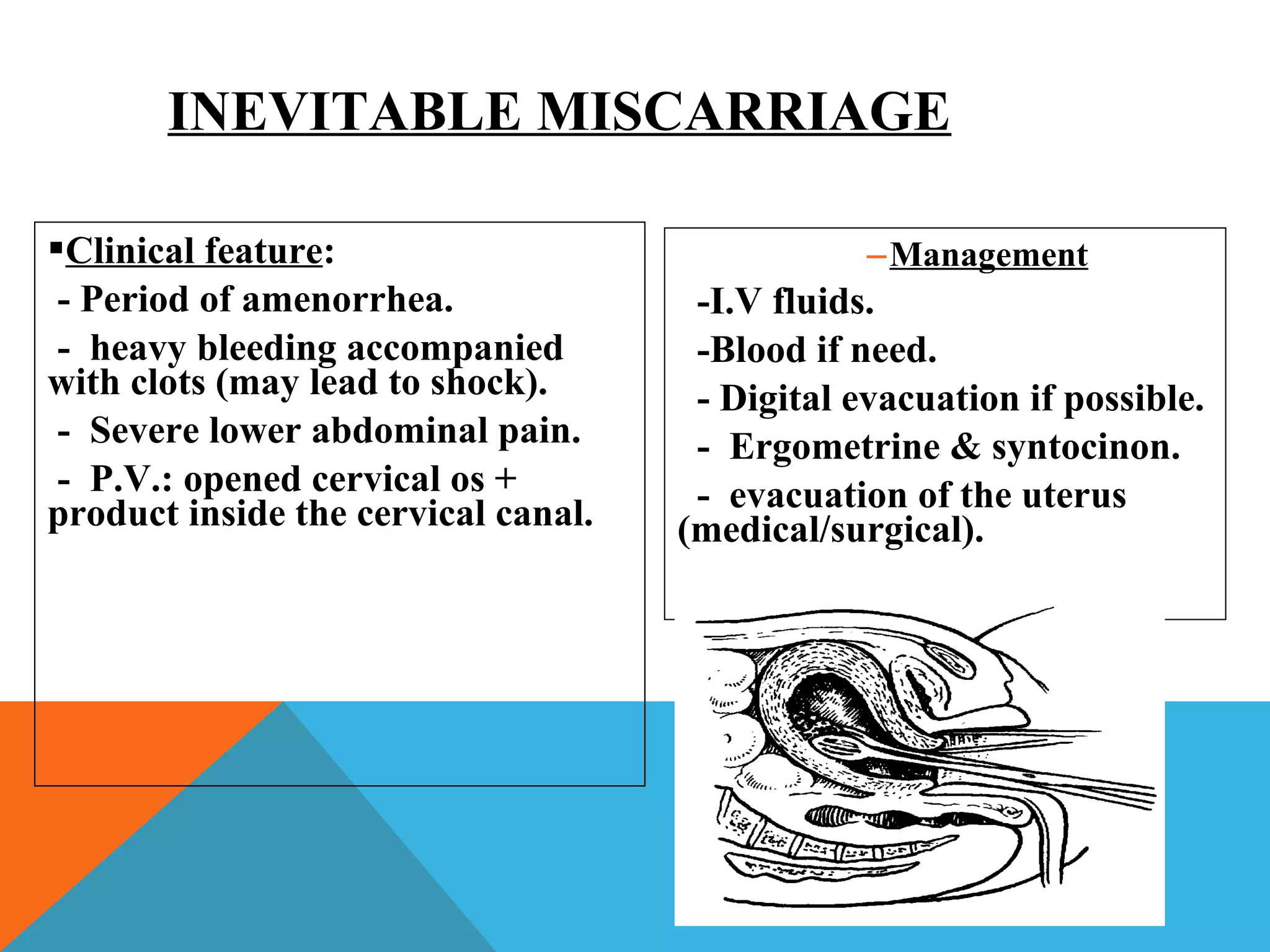 Miscarriages | PPT