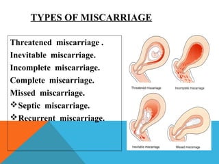 Miscarriages | PPT