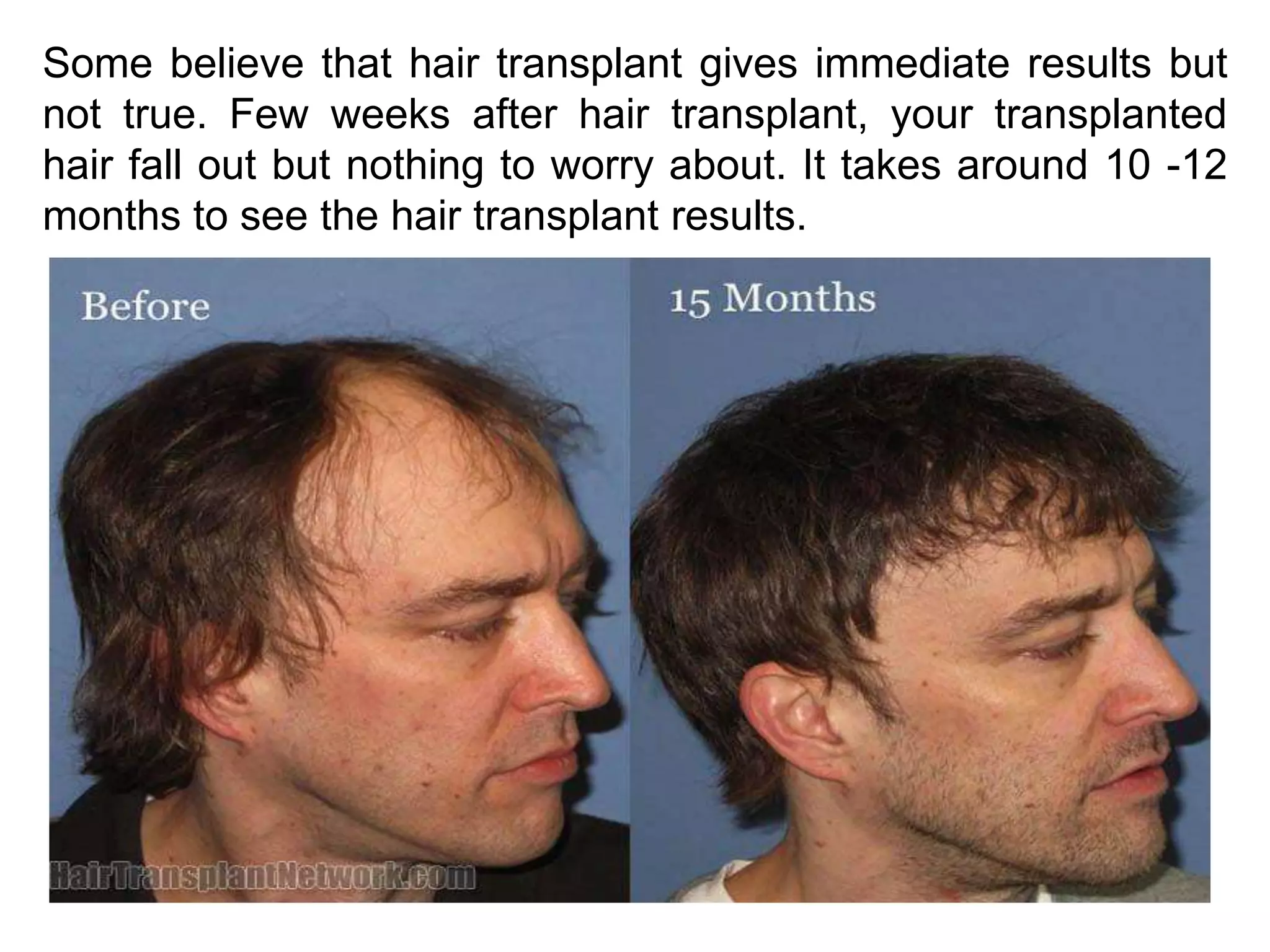 MISCONCEPTIONS ABOUT HAIR TRANSPLANT | PPTX