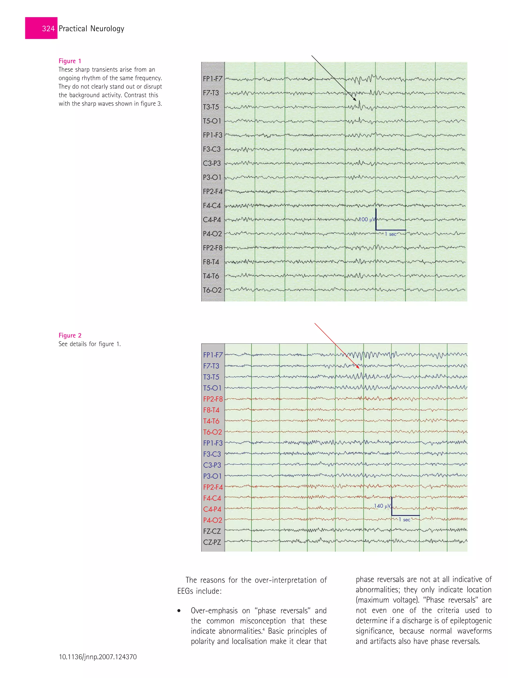 Misdiagnosis of epilepsy due to errors in eeg interpretation | PDF ...