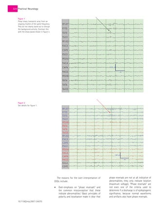 Misdiagnosis of epilepsy due to errors in eeg interpretation | PDF ...