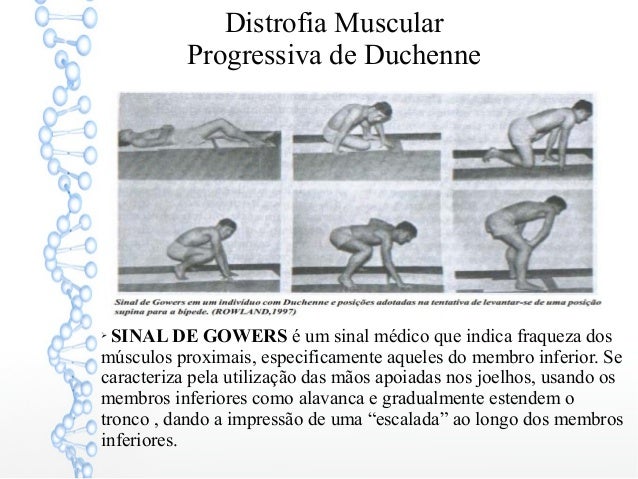Distrofia Muscular Progressiva de Duchenne