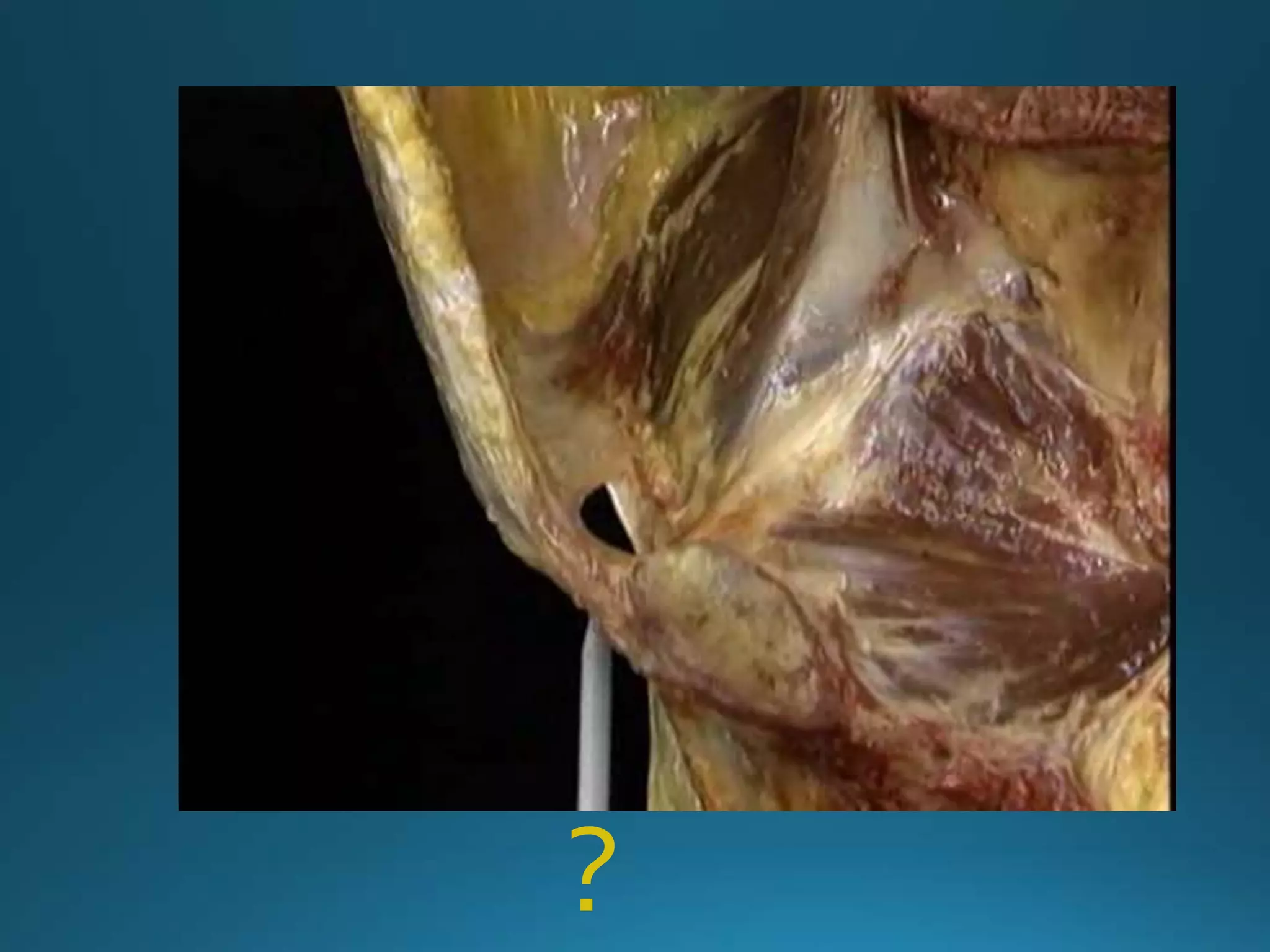Laparoscopic Anatomy of the Inguinal Region | PPTX