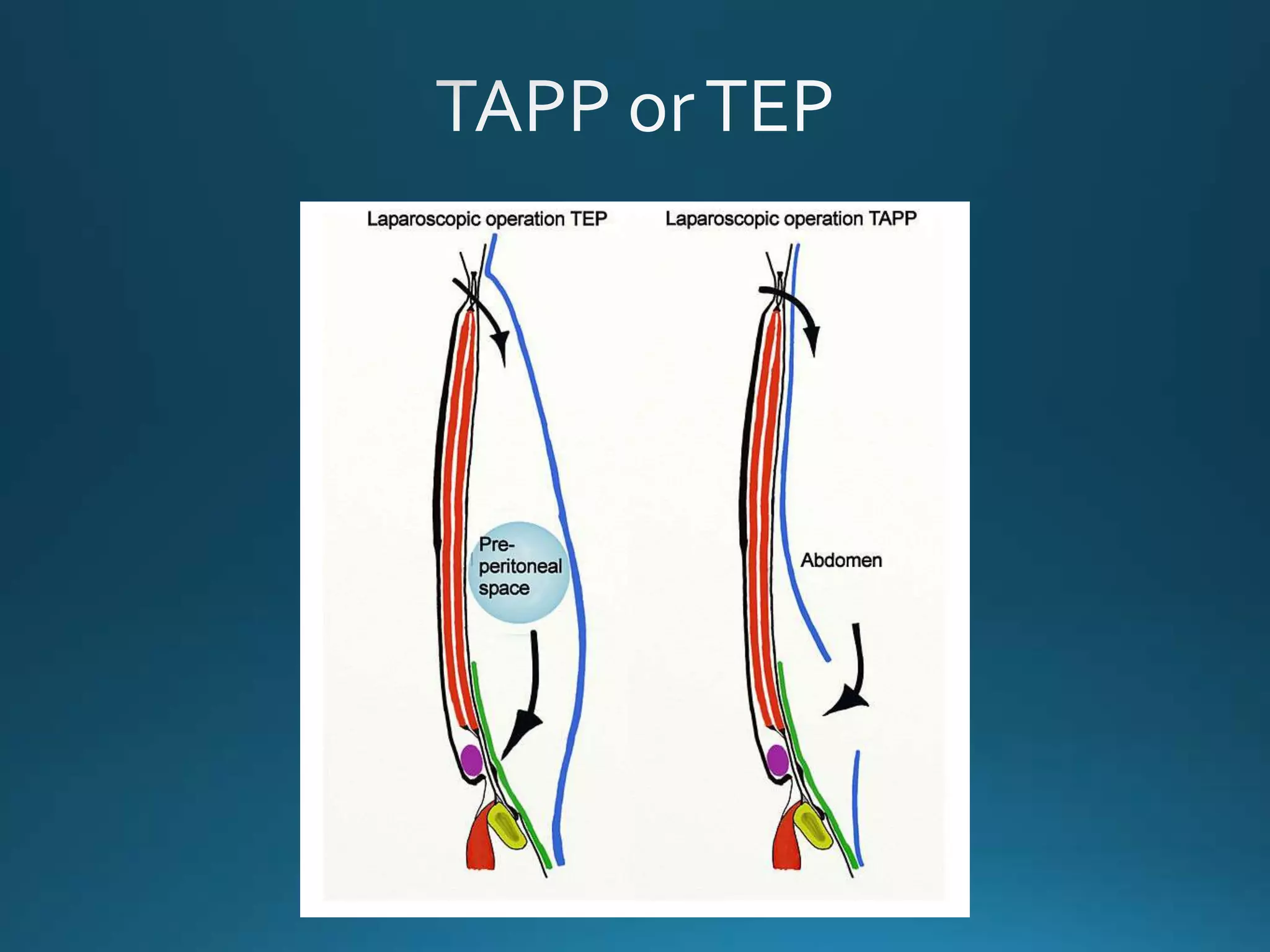 Laparoscopic Anatomy of the Inguinal Region | PPT