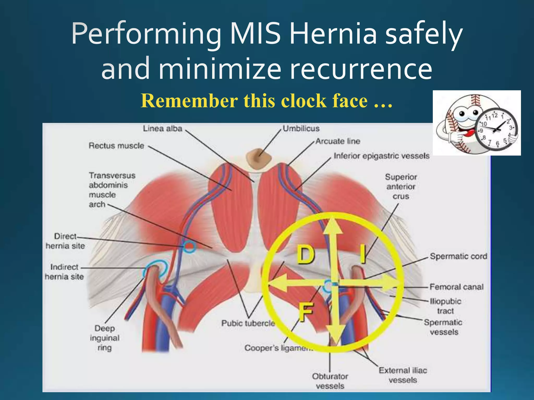 Laparoscopic Anatomy of the Inguinal Region | PPTX