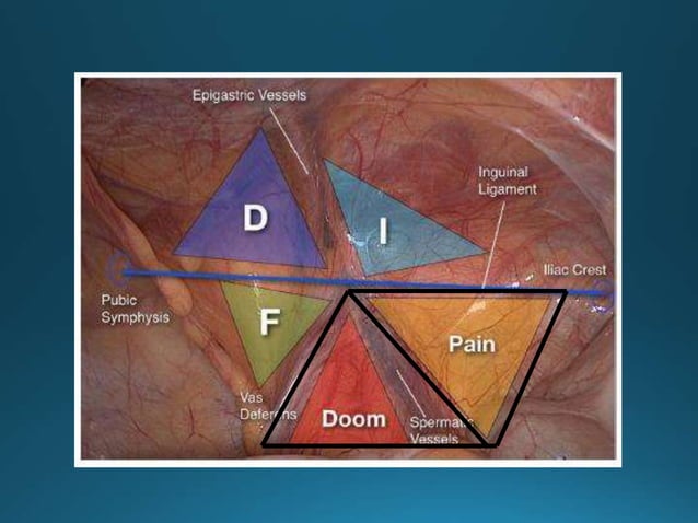 Laparoscopic Anatomy of the Inguinal Region | PPTX | Death, Injury, or ...