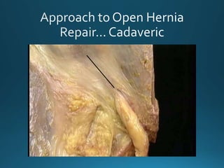Laparoscopic Anatomy of the Inguinal Region | PPTX