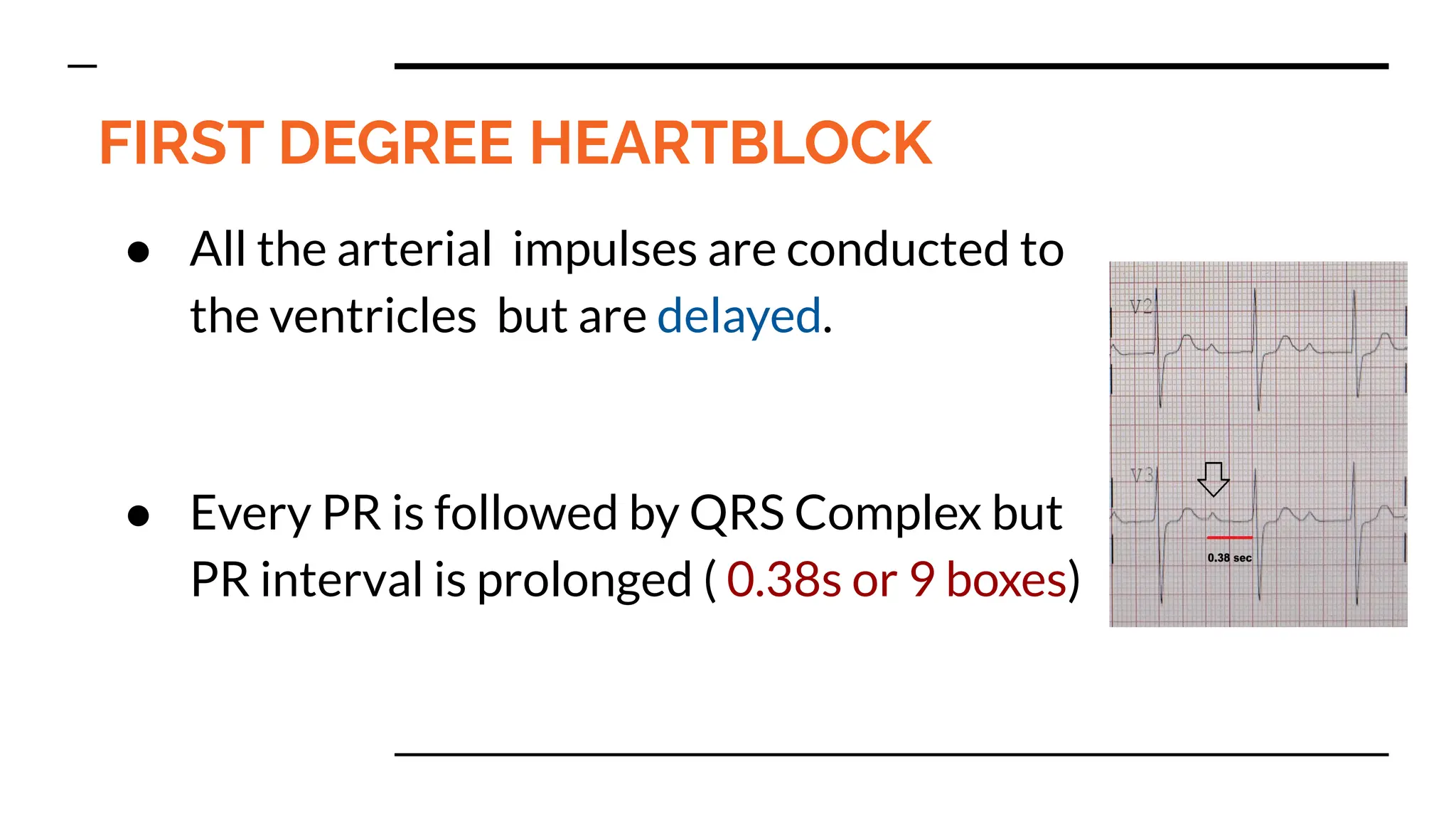 Types of heart blocks with it's ecg variations | PDF