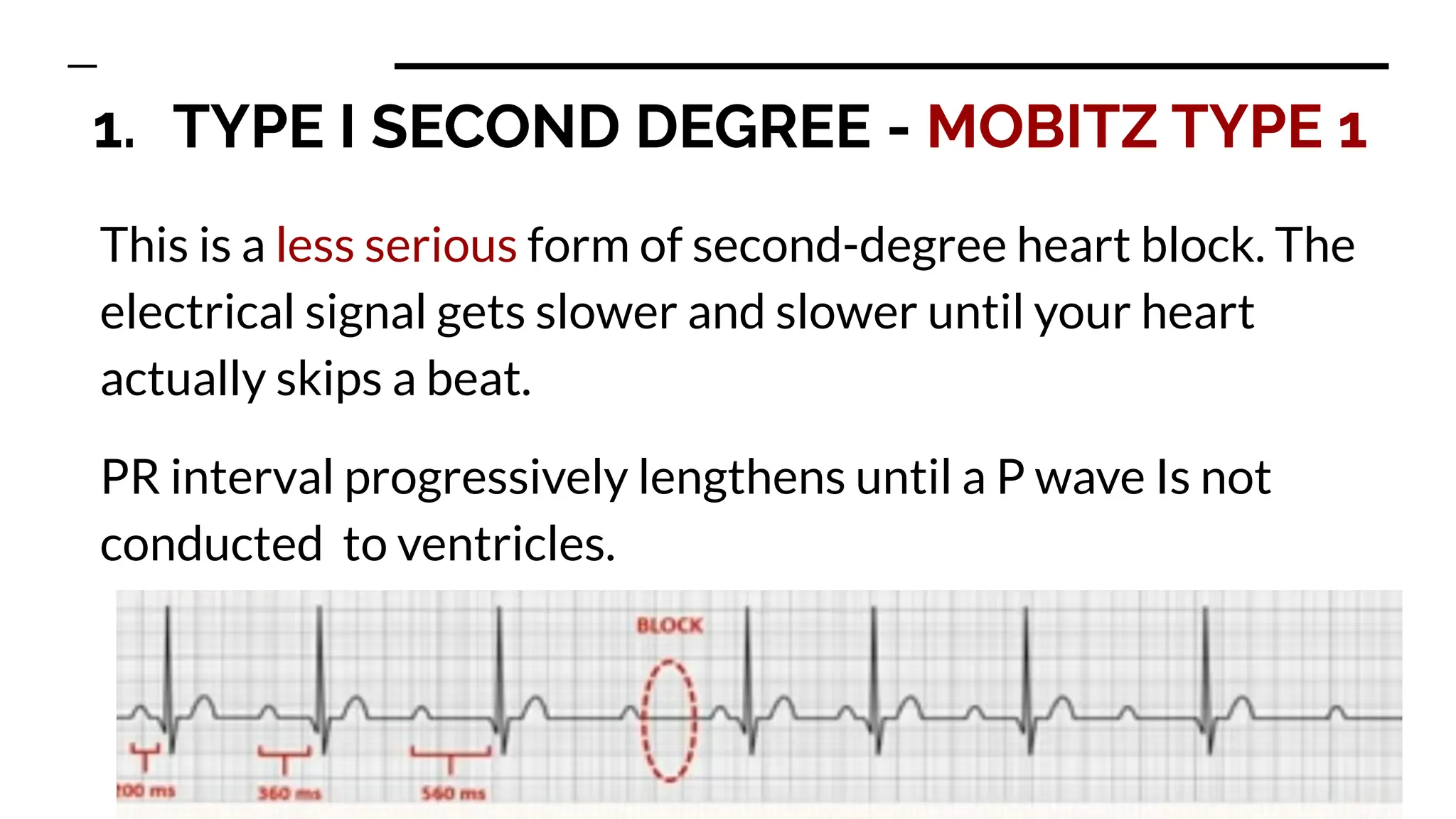 Types of heart blocks with it's ecg variations | PDF