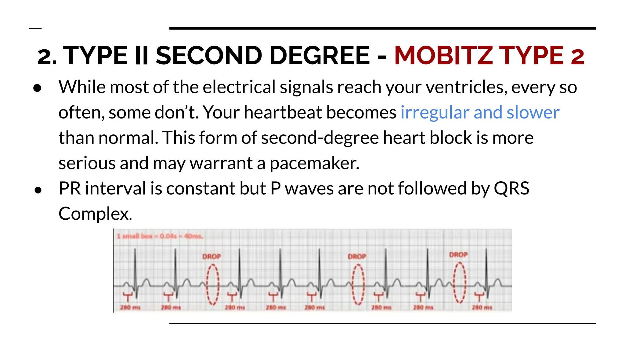 Types of heart blocks with it's ecg variations | PDF