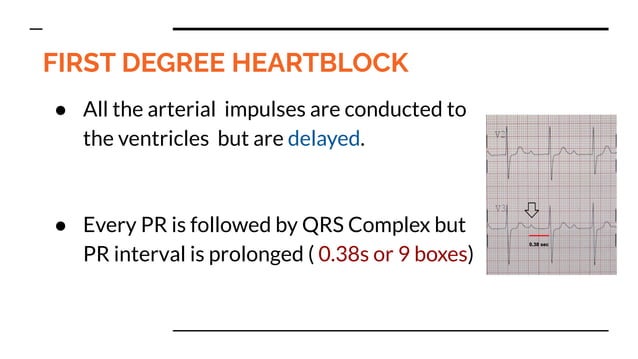 Types of heart blocks with it's ecg variations | PPT