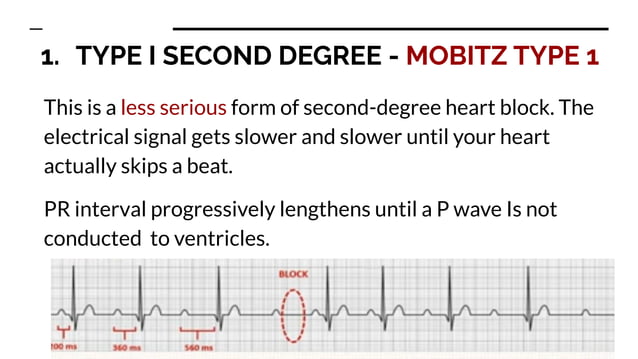 Types of heart blocks with it's ecg variations | PPT