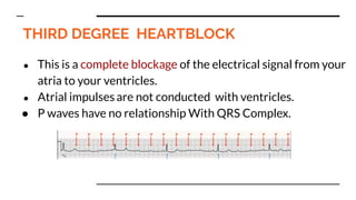 Types of heart blocks with it's ecg variations | PPT