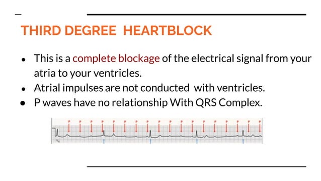 Types of heart blocks with it's ecg variations | PPT