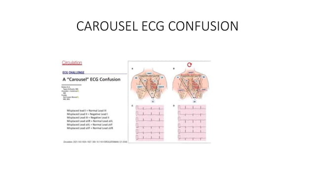 MISPLACED ECG LEADS.pptx