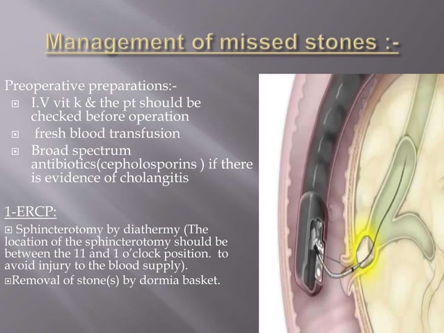 Missed biliary stones | PPTX | Digestive Disorders | Diseases and ...