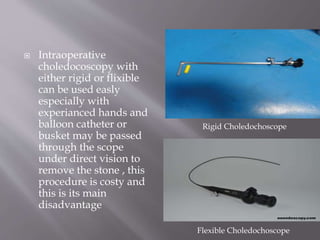 Missed biliary stones | PPTX | Digestive Disorders | Diseases and ...