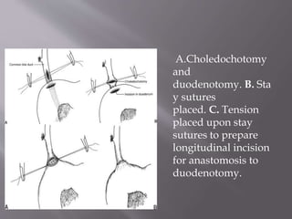 Missed biliary stones | PPTX | Digestive Disorders | Diseases and ...