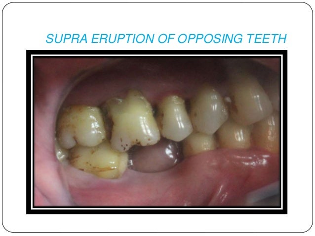 Missing both side lower molar replace with single piece basal implant