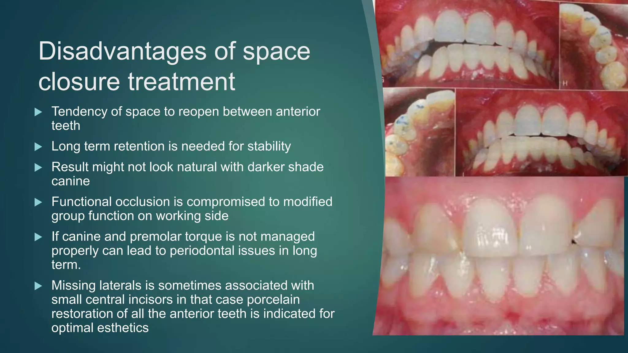 Missing maxillary lateral incisor | PPTX