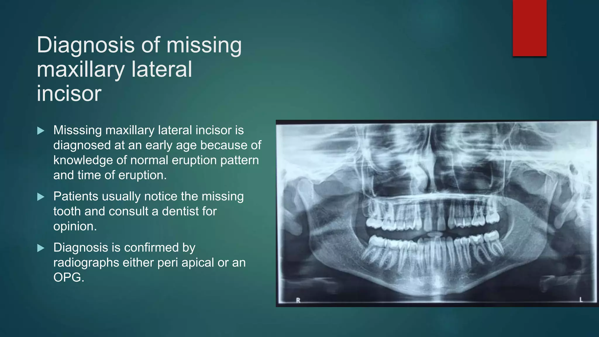 Missing maxillary lateral incisor | PPTX