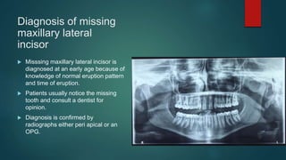 Missing maxillary lateral incisor | PPTX