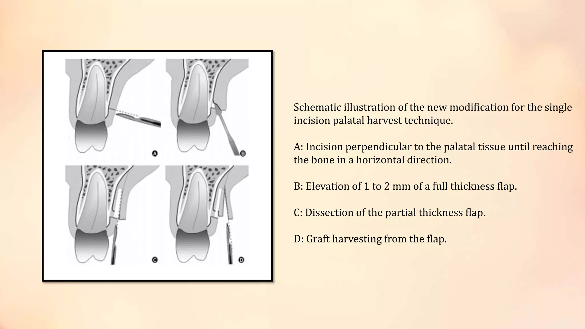 Minimally invasive surgical techniques in periodontics | PPTX