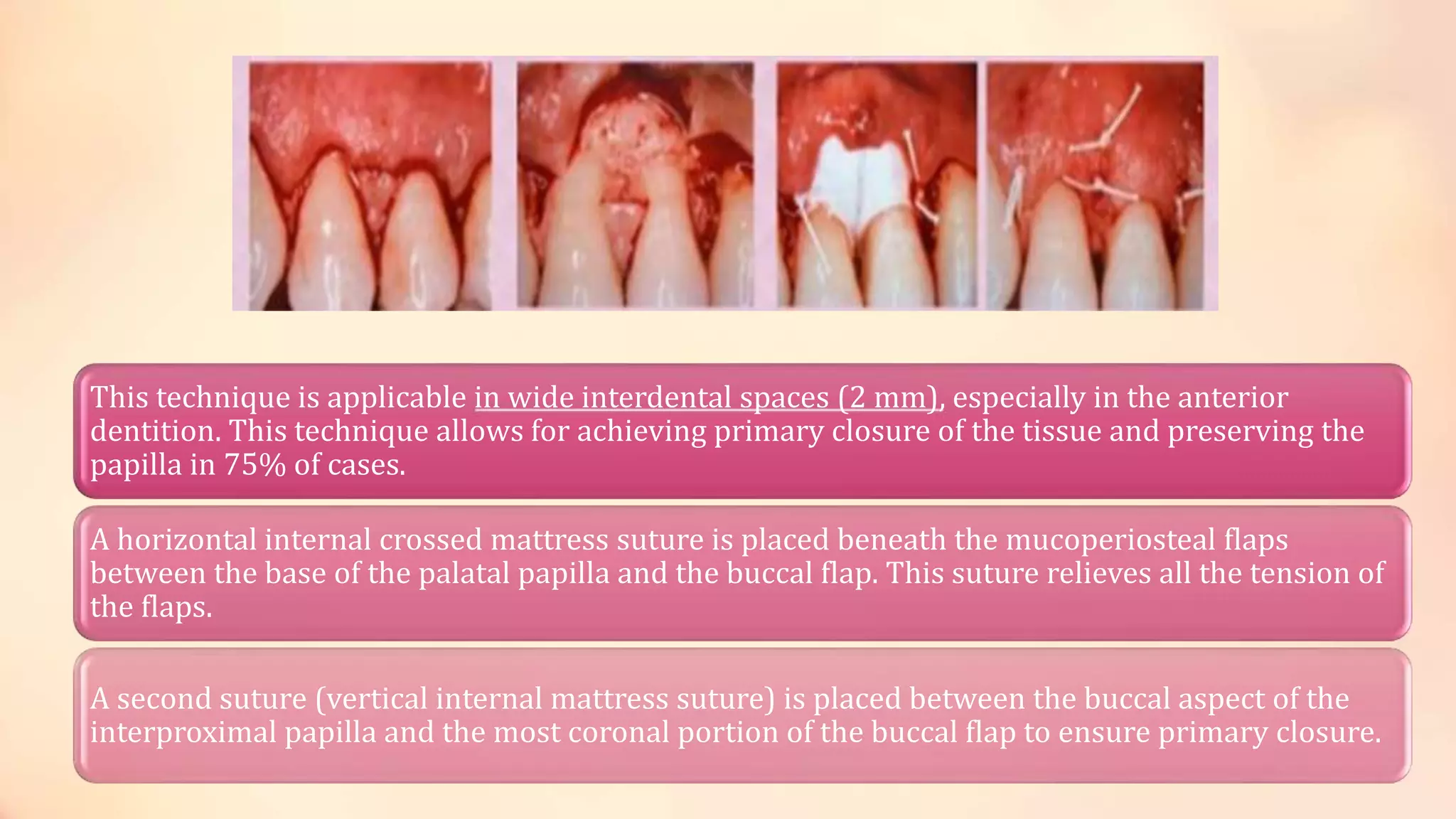 Minimally invasive surgical techniques in periodontics | PPTX