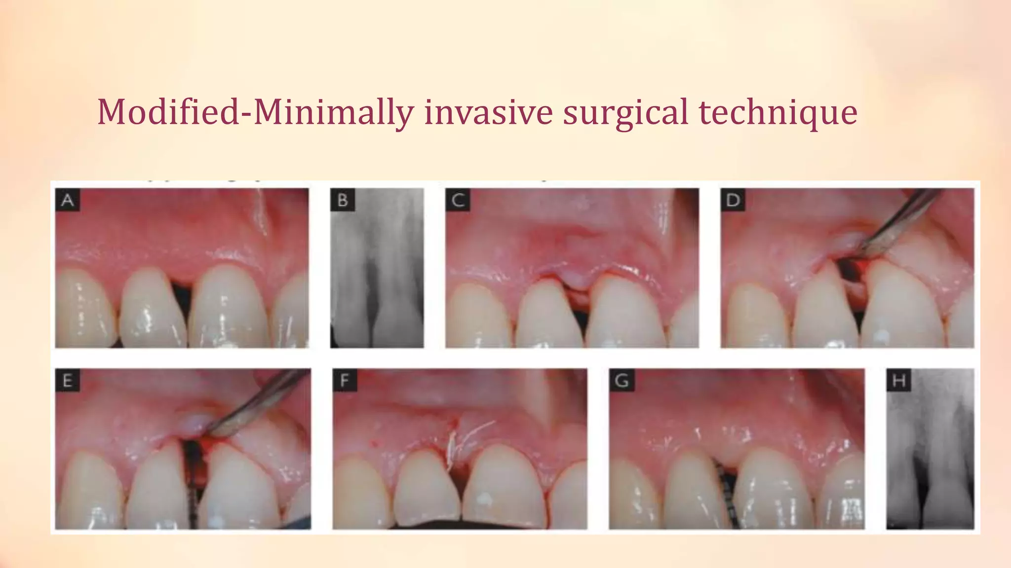 Minimally invasive surgical techniques in periodontics | PPTX