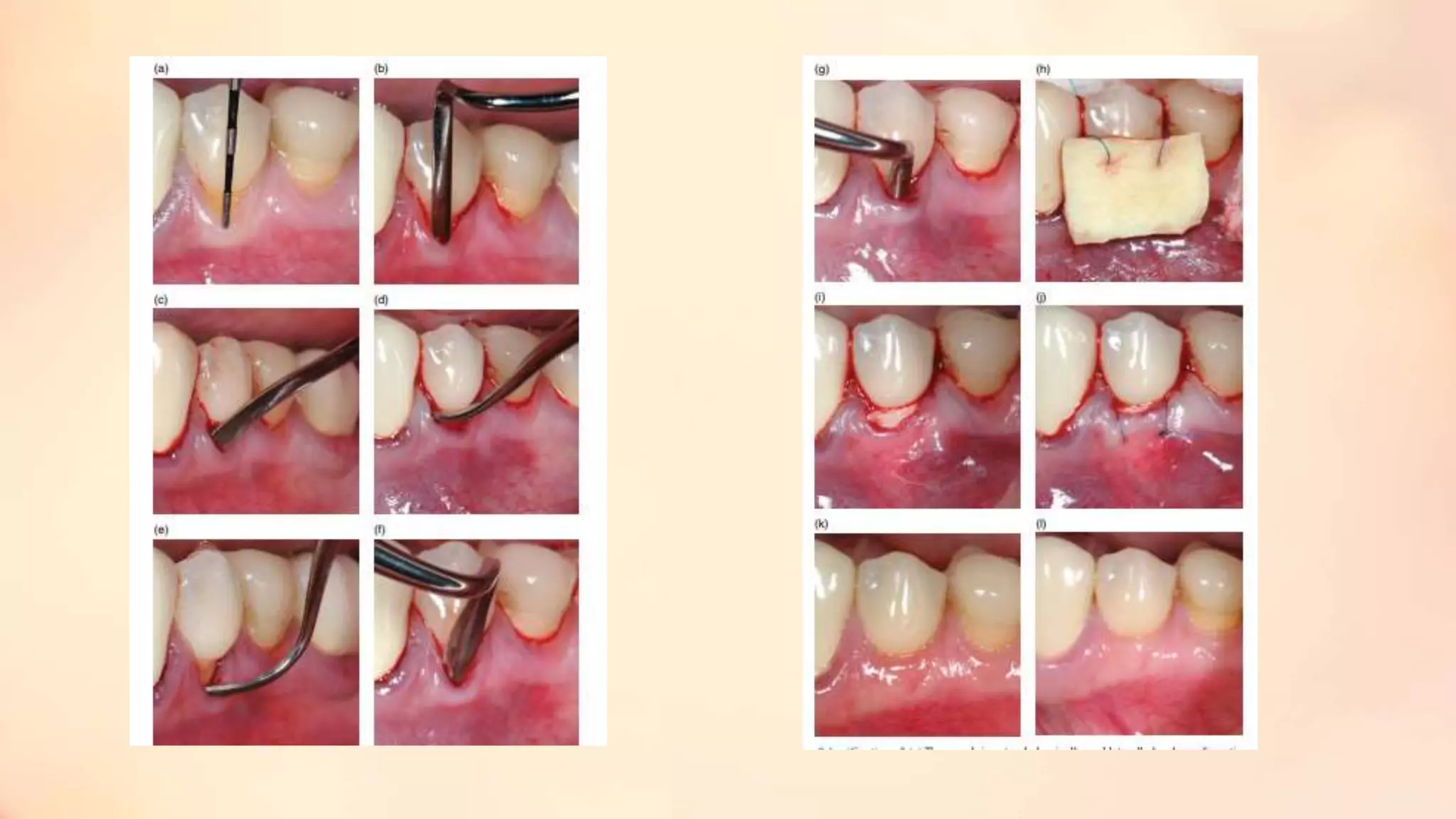 Minimally invasive surgical techniques in periodontics | PPTX