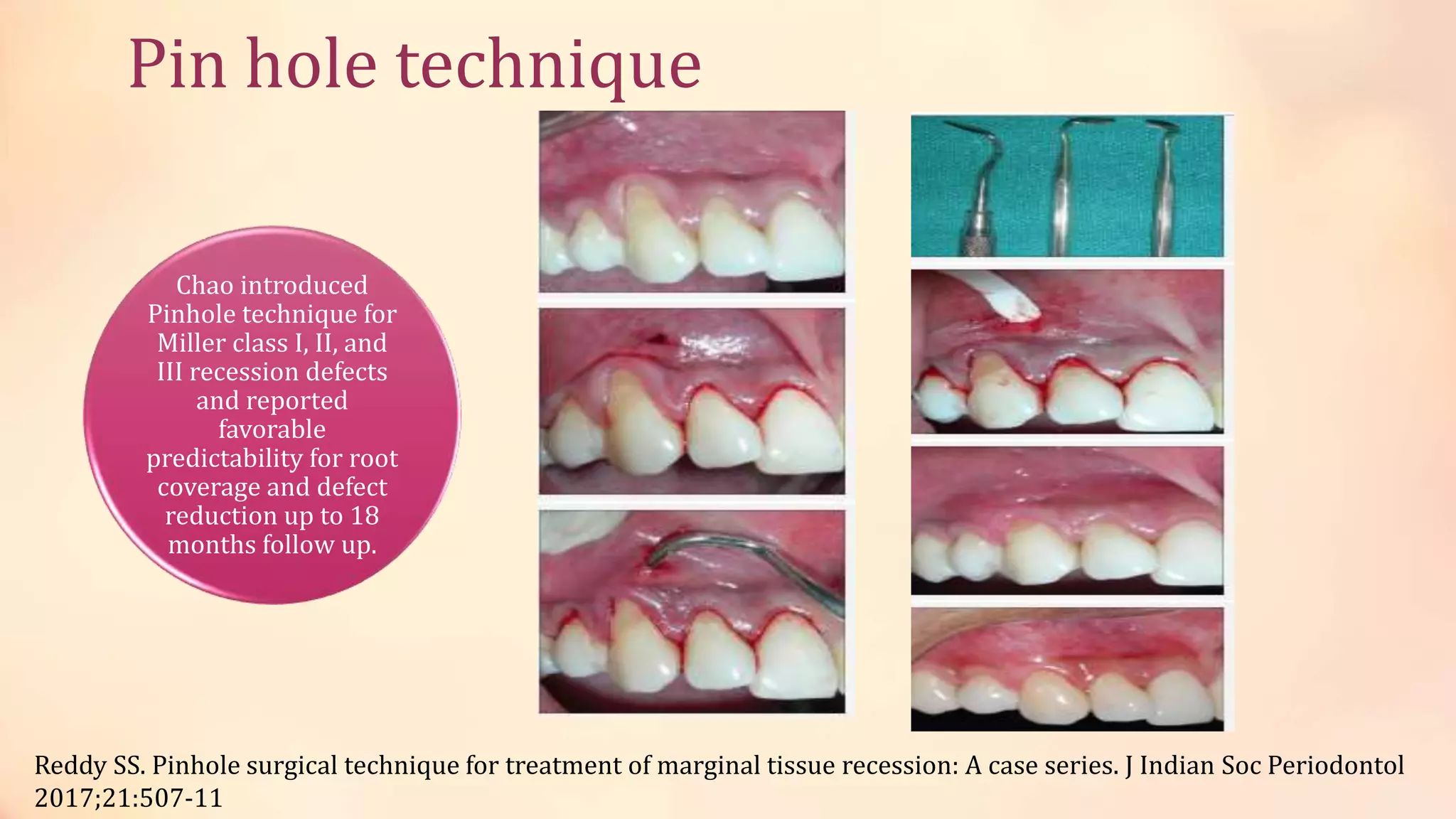 Minimally invasive surgical techniques in periodontics | PPTX
