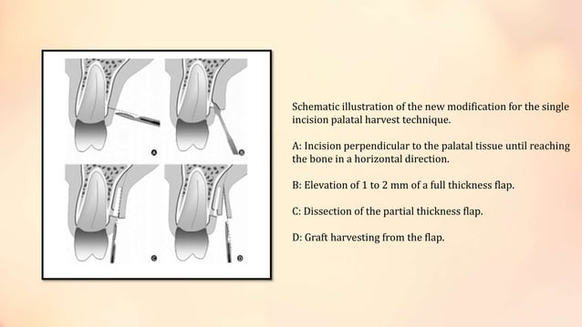 Minimally invasive surgical techniques in periodontics | PPTX | First ...