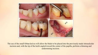Minimally invasive surgical techniques in periodontics | PPTX