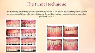Minimally invasive surgical techniques in periodontics | PPTX