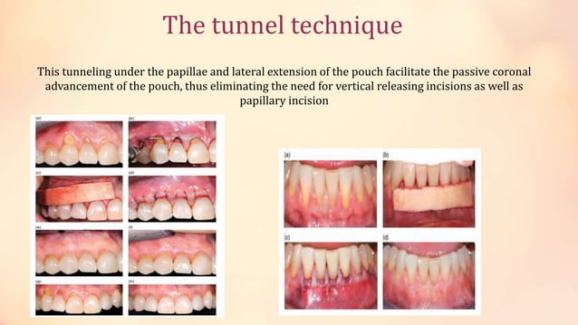 Minimally invasive surgical techniques in periodontics | PPTX | First ...